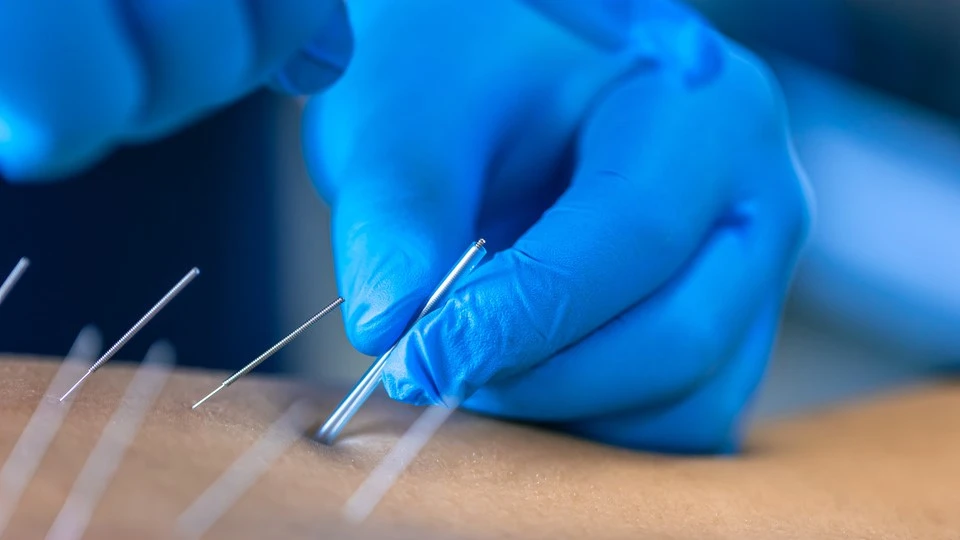 Exploring Functional Dry Needling: A Physical Therapist’s Guide to Pain ...